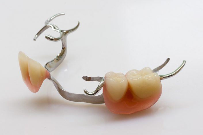 Modellguss, Unterkiefer | Zahnwerkstatt Dentallabor Wernigerode